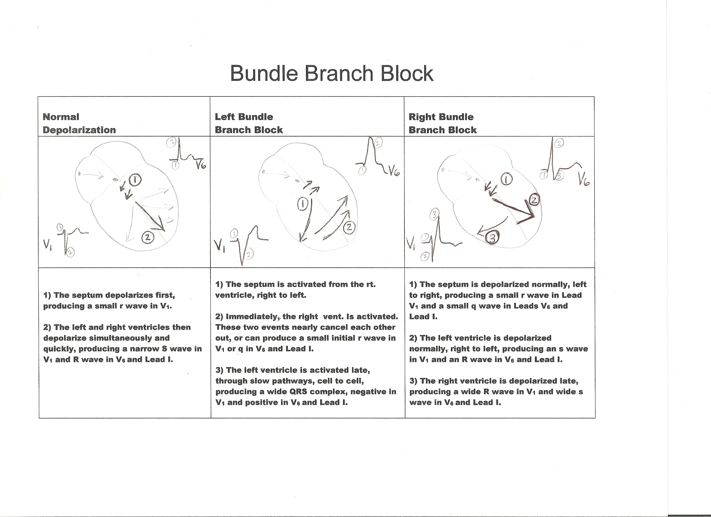 Bundle Branch Block Ecg Guru Instructor Resources